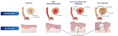 Understanding Eosinophlic Esophagitis (EoE)