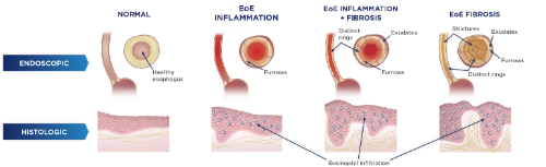 Understanding Eosinophlic Esophagitis (EoE)