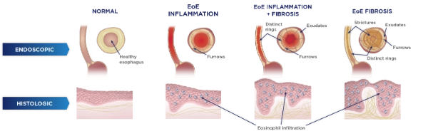 Understanding Eosinophlic Esophagitis (EoE)