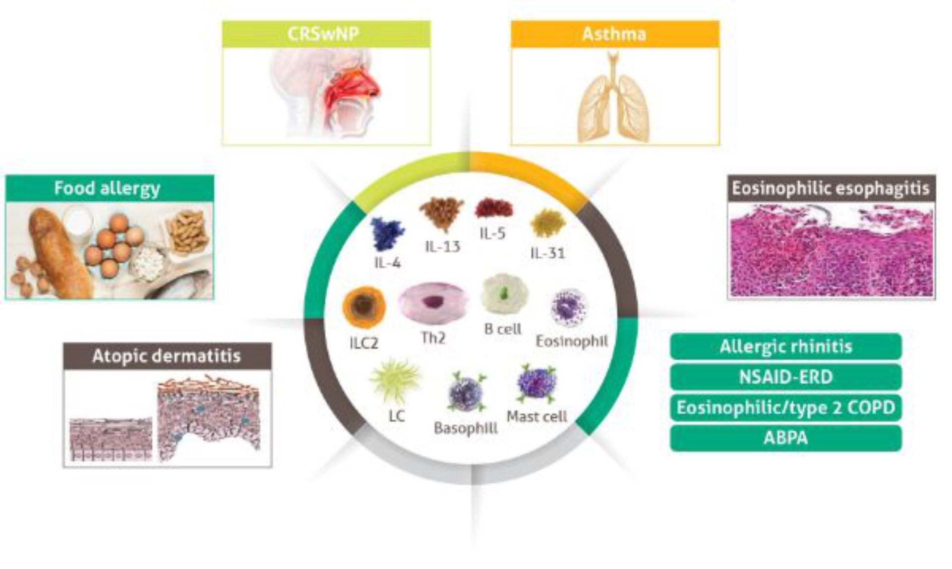 About Type 2 Inflammation – Asthma