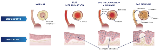 Understanding Eosinophilic Esophagitis (EoE)