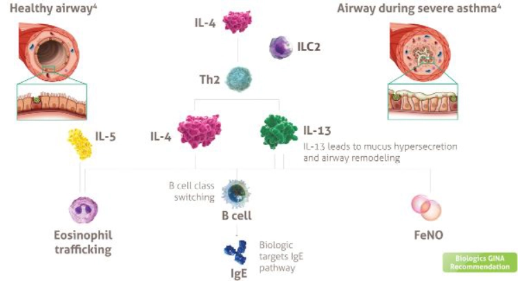 About Type 2 Inflammation – Asthma