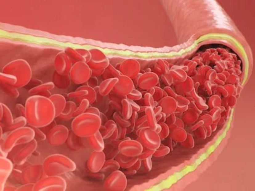 Dyslipidemia