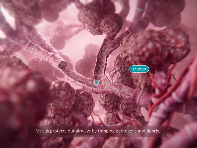 The Role of Mucus Plugging in Asthma and Its Clinical Burden