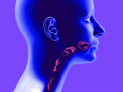 Eosinophilic Esophagitis